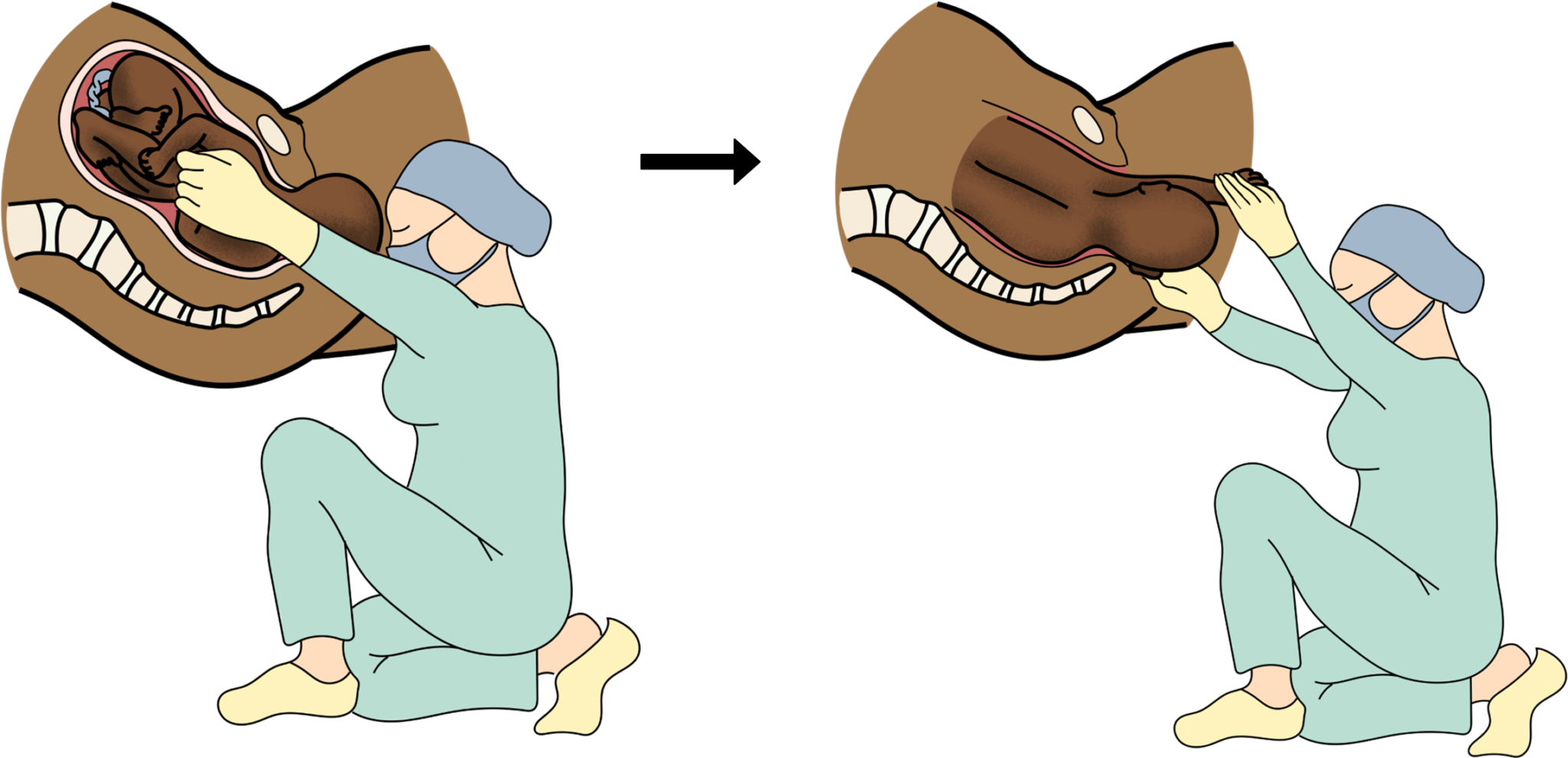 Dystocie des épaules - Obstetricks