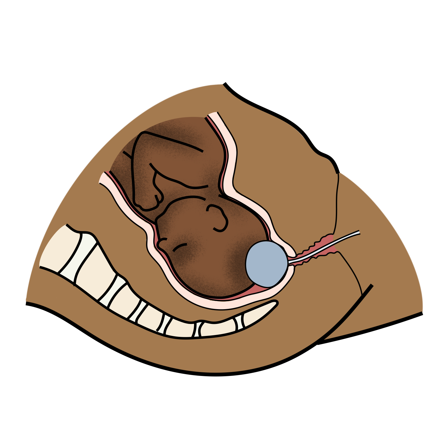 Déclenchement - Obstetricks