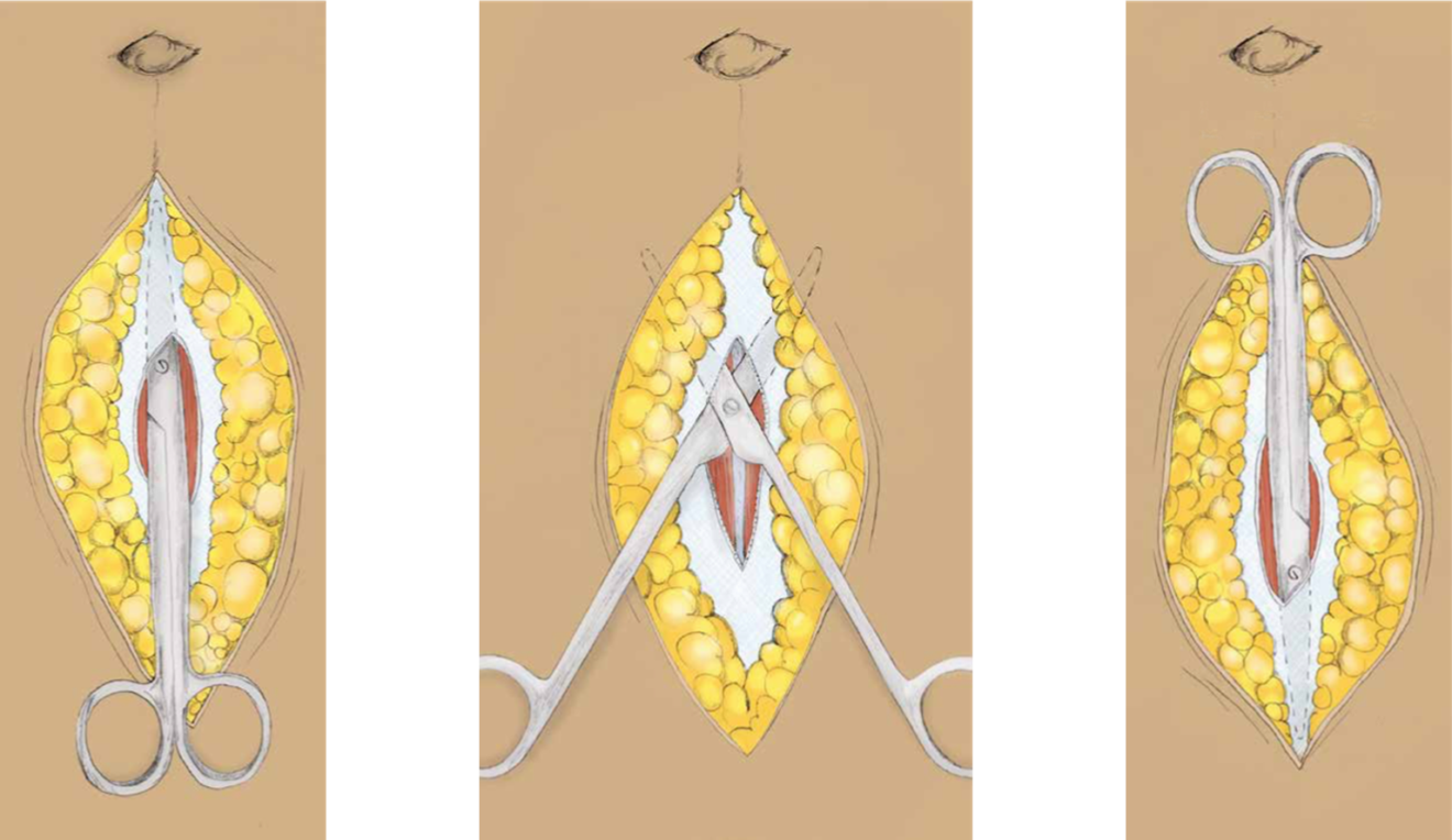 Césarienne - Obstetricks