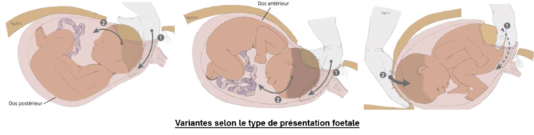 Césarienne - Obstetricks