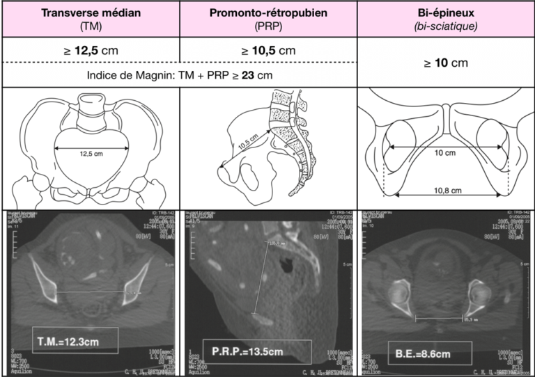 Pelvimétrie - Obstetricks